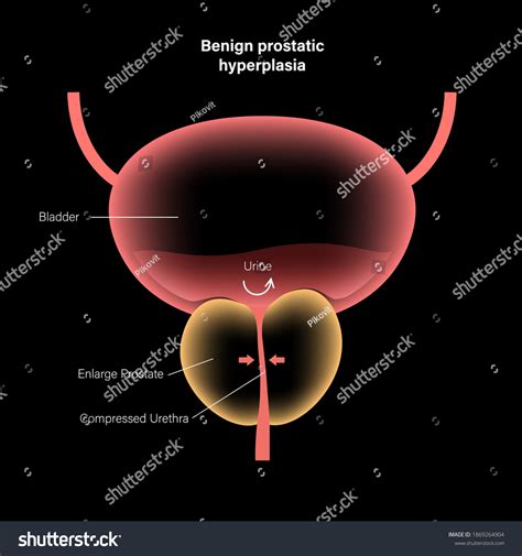 Benign Prostatic Hyperplasia Logo Clinic Bph Stock Vector Royalty Free