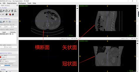 医学图像预处理之可视化如何可视化niigz文件 Csdn博客