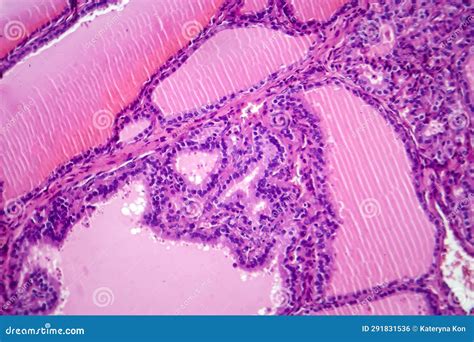 Toxic Goiter Light Micrograph Stock Photo Image Of Thyroid Disorder