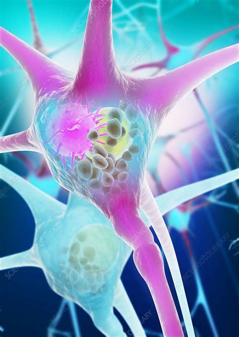 Lewy Body In Neuron In Parkinsons Disease Illustration Stock Image