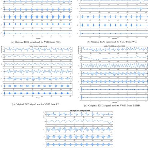 Samples Of Vmd Of Ecg Signals From Five Classes Of Beats Download