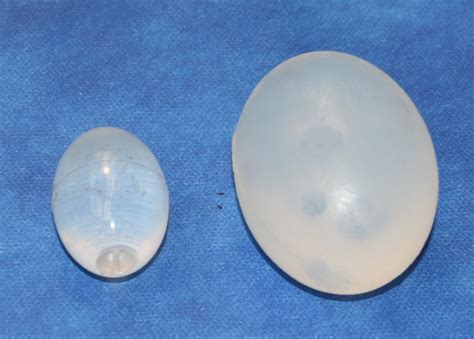 Plastic Surgery Case Study XL Testicle Implants In Penile Scrotal Disproportion Explore