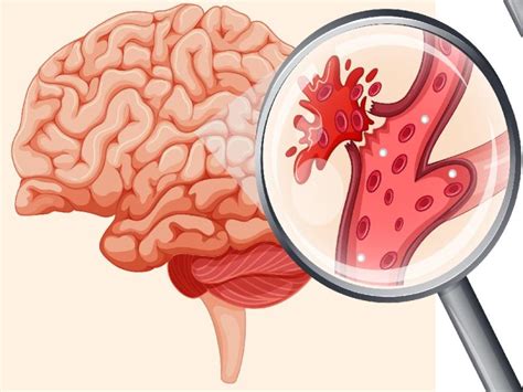 Hemorragia Cerebral