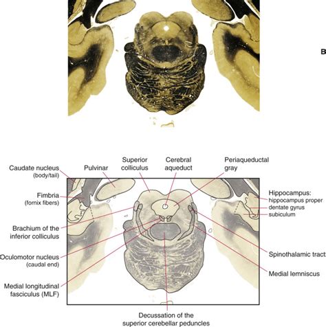 Coronal Sections Neupsy Key