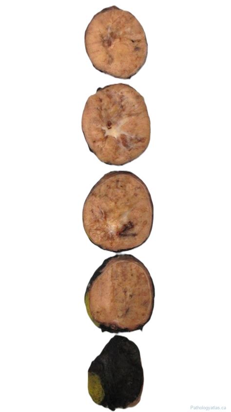 Non Invasive Follicular Thyroid Neoplasm With Papillary Like Nuclear Features Archives Ottawa