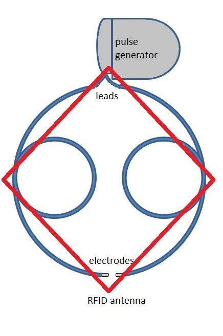 Implantable Neurostimulator System Configuration Top View Each Download Scientific Diagram