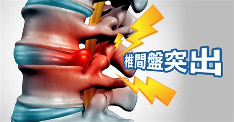 坐骨神經痛的真相 椎間盤突出 Medimart 樂康軒