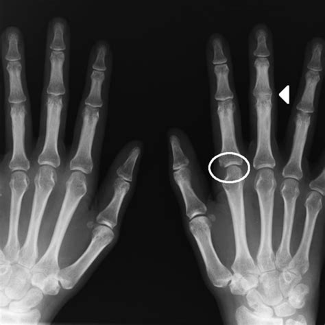 Skin Findings On Admission Erythematous Plaques With Annular