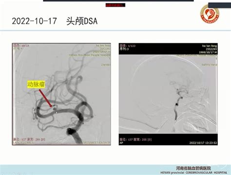 右侧大脑中动脉动脉瘤