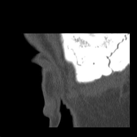 Normal Temporal Bone Ct With Annotated Images Radiopaedia 84293 99584