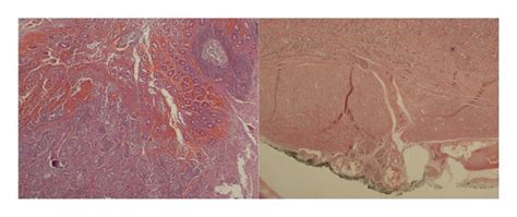 In Hematoxylin And Eosin Sections Tumoral Tissue Infiltrating The Download Scientific Diagram