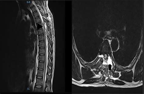 Spinal Arachnoid Cyst