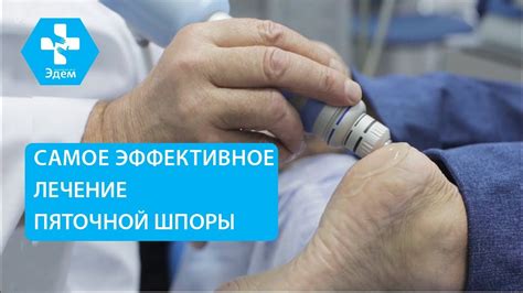 👣 Как лечить пяточную шпору методом ударно волновой терапии Пяточная шпора как лечить ЭДЕМ 12