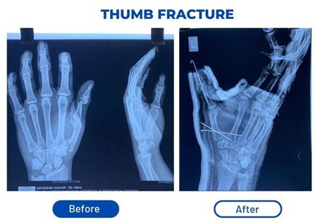Fracture Plaster And Surgery Drsanjeed Pujary