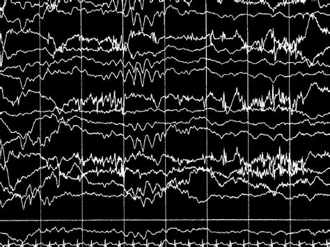 Eeg In Neonates Normal Variants And Pathological Traces Ppt