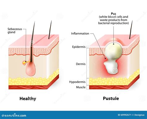 Healthy Skin And Pustules Stock Vector Illustration Of Dermis 69992671