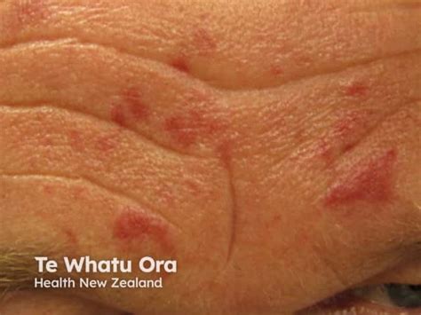 Fluorouracil Cream Before And After