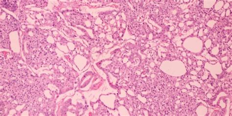 Tumor renal izquierdo de 10x 8cm Sociedad Latinoamericana de Patología
