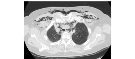 Ct Scan Showing Both Mediastinal Emphysema And Subcutaneous Emphysema