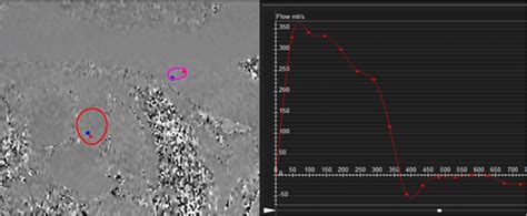 Velocity Encoded Phase Contrast Sequence For Evaluation Of Aortic Flow
