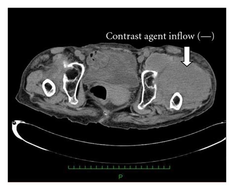 Contrast Enhanced Ct Scan At 2 Months After The Embolization Download Scientific Diagram
