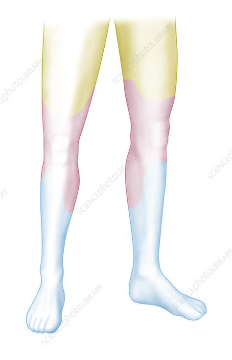 Arterial Stenosis Stock Image C029 7648 Science Photo Library