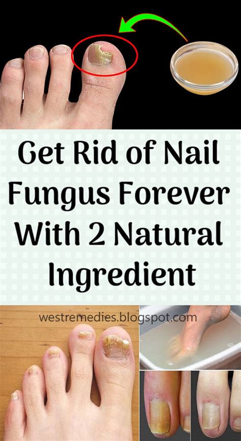 Get Rid Of Nail Fungus Forever With 2 Natural Ingredient