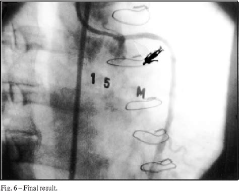 Pdf Cutting Balloon Angioplasty For Intrastent Restenosis Treatment