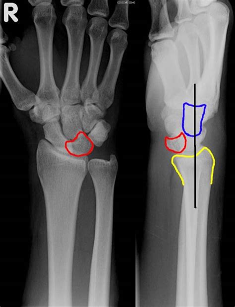 Perilunate And Lunate Dislocations Wikem