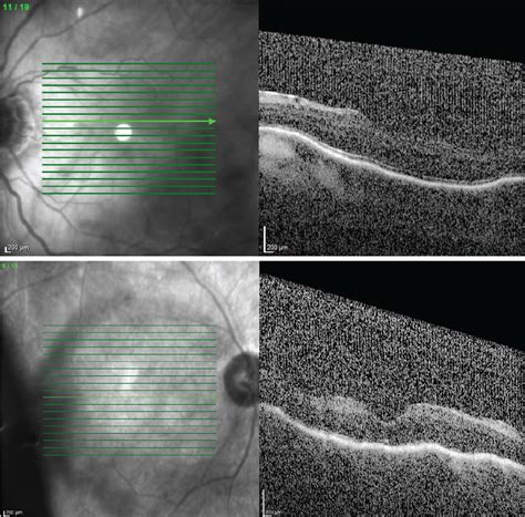 Variable Vision After Glaucoma Surgery
