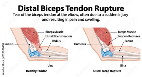 Comparison Of Healthy And Ruptured Biceps Tendon Stock Vector Adobe Stock