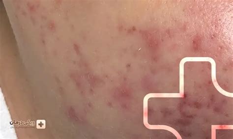 لکه‌های سیاه روی پوست چرا ایجاد می‌شود؟ راه درمان ️