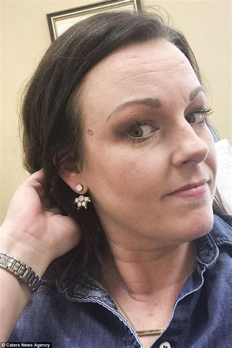 Mother Has A Hole In Her Face Due To Skin Cancer Daily Mail Online