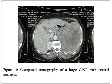 Voluminous Gastric Stromal Tumors Place Of Surgery About 5 Cases