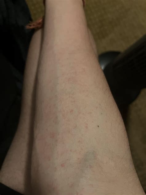 Scabies Post Scabies Rscabies