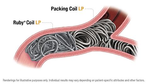 Coils Used For Embolization At Scarlett Madgwick Blog
