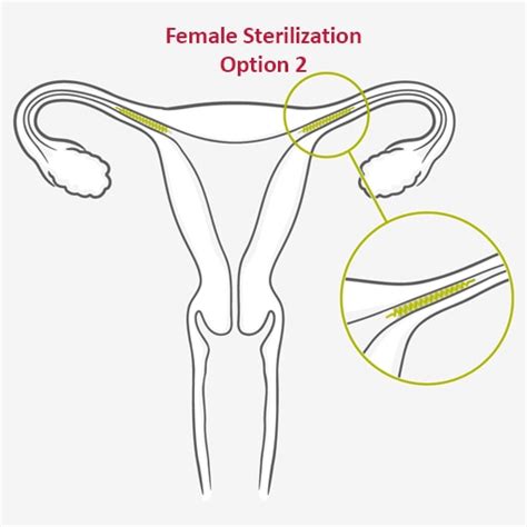 Sterilization Permanent Method