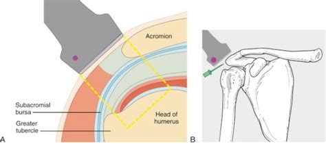 Intraarticular Shoulder Injections—anterior Approach Fluoroscopic