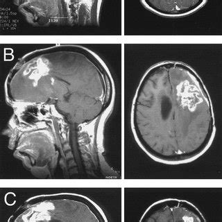 Forty Two Year Old Female Patient With A Recurrent Left Frontal Download Scientific Diagram