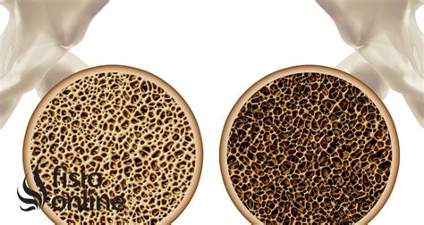 Osteoporosis Causas Síntomas Y Tratamiento Dietético Y Nutricional
