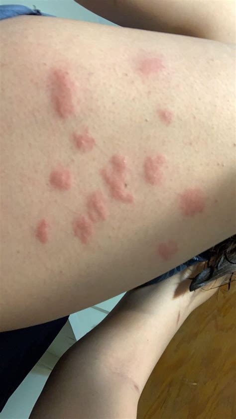 After Hiking I Had Bug Bites Everywhere This Is The Biggest Cluster I Found What Does It Look