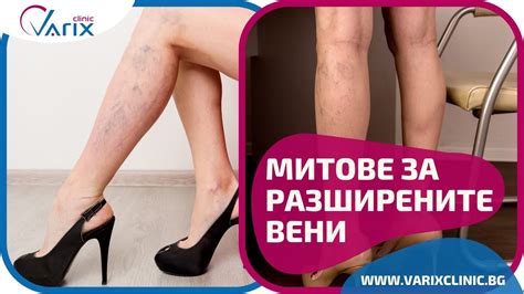 Митове за разширените вени Youtube