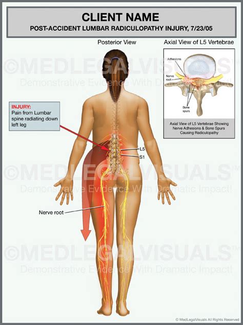 Lumbar Radiculopathy