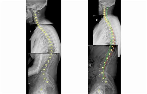Thoracic Hyperkyphosis Solutions Chiropractic Health And Wellness