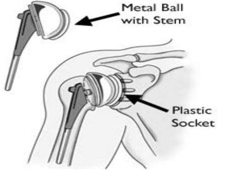 Total Shoulder Joint Replacement Finite Element Method The Finite
