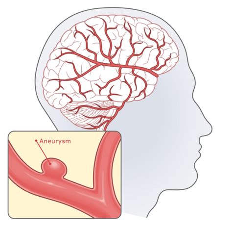 How To Prepare For Brain Aneurysm Coiling Procedure Supreme Vascular And Interventional Clinic