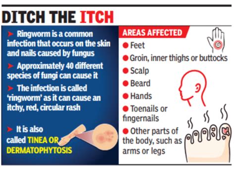 Why Ringworm May Be Turning Drug Resistant Delhi News Times Of India