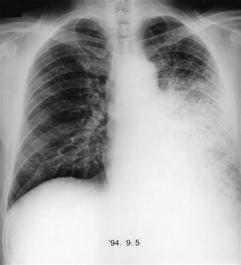 Chest Radiograph On Hospital Admission Showing Diffuse Infiltrative