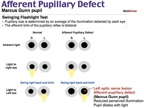 Afferent Pupillary Defect Medical School Stuff Medical School