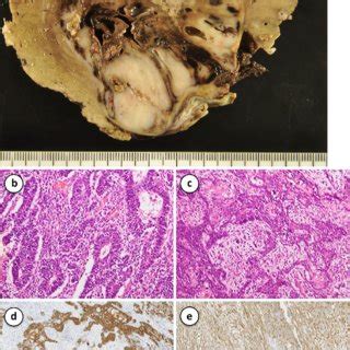 Figure6 Pathological Findings A Macroscopic View Of The Resected